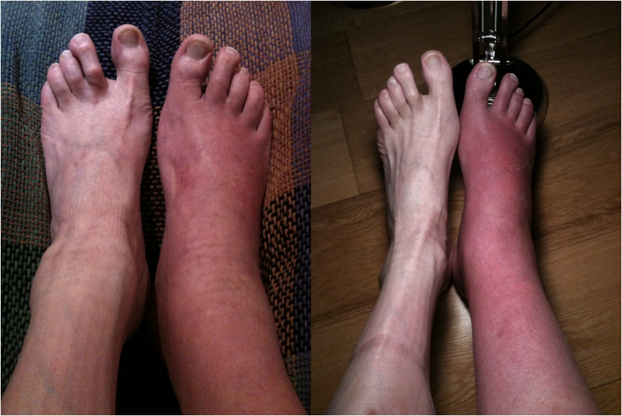 Living with Complex Regional Pain Syndrome and Bone Marrow Oedema ...